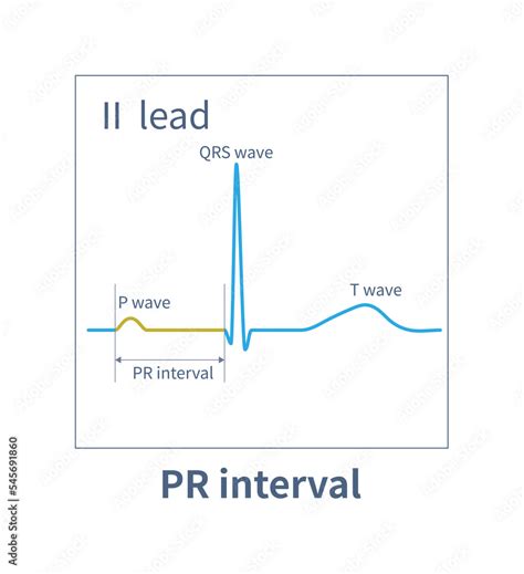 Image result for PR Interval ECG