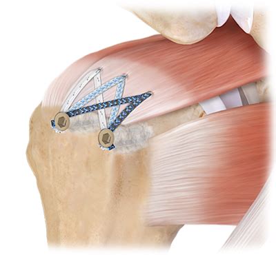 Image result for SpeedBridge Rotator Cuff