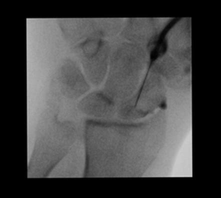 Image result for Wrist Arthrogram