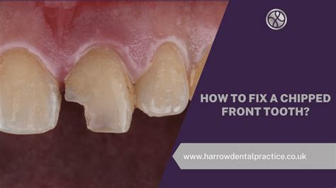 Image result for DIY Front Tooth Chip Repair Kit