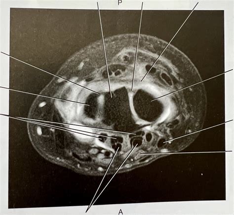 Image result for Wrist Arthrogram