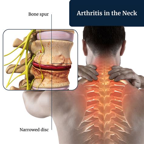 Image result for Neck Arthritis Computer