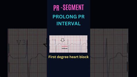 Image result for PR Interval ECG