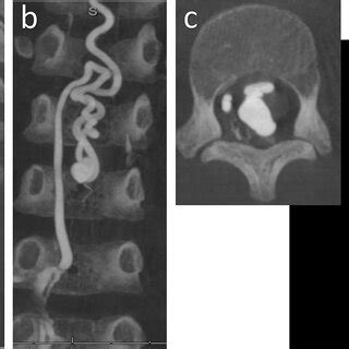Image result for Spinal Angiogram