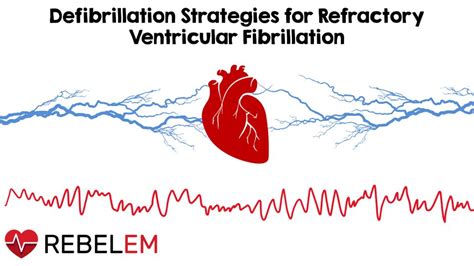 Image result for Defibrillation