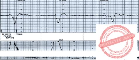 Image result for Variable Decelerations