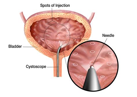 Image result for How Is Botox Injected into the Bladder