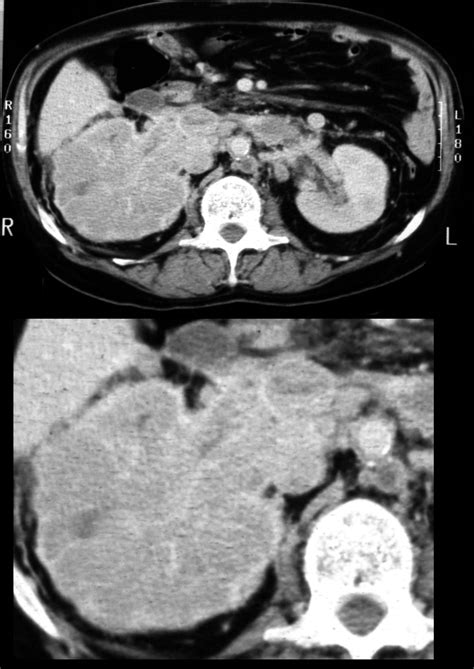 Image result for Nephrogram Phase Timing