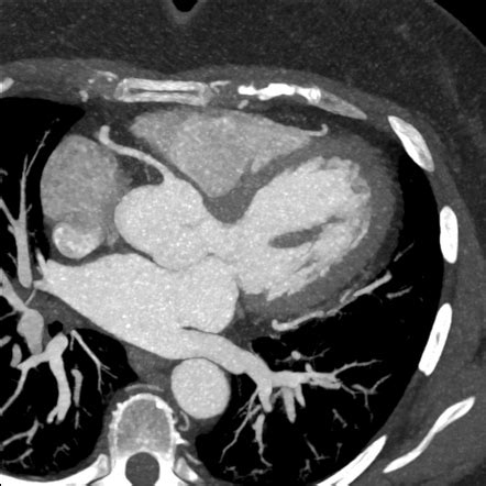 Image result for Normal Coronary CT Angiogram