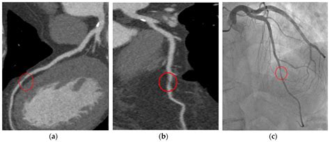 Image result for Normal Coronary CT Angiogram