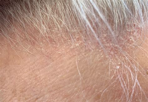 Image result for Seborrhea Capitis