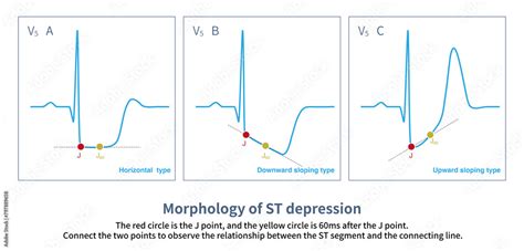 Image result for Types of ST Depression