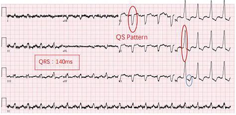 Image result for Incomplete Bundle Branch Block Left Treatment