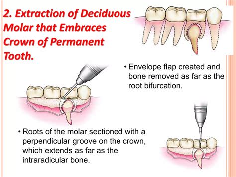 Image result for Principles of Tooth Extraction
