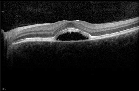 Image result for Oct Interpretation