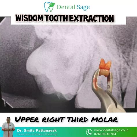 Image result for Wisdom Tooth Upper Right Extraction
