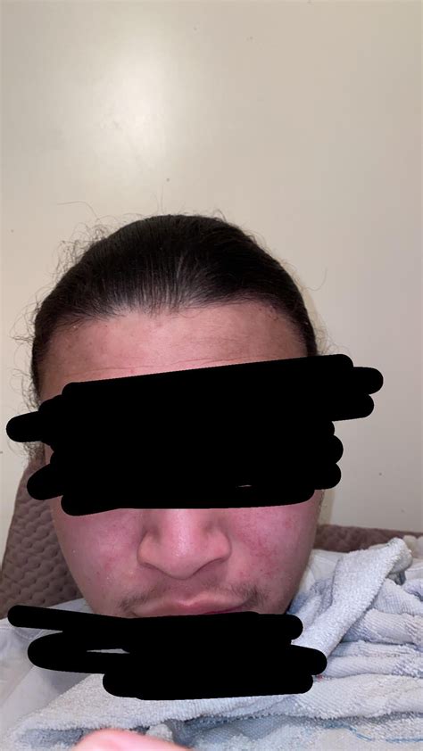 Image result for Seb Derm