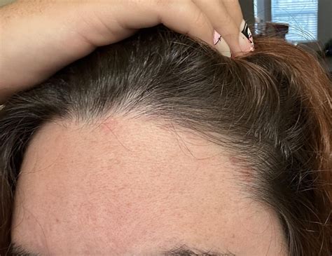 Image result for Seb Derm