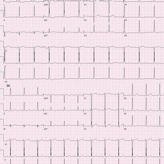Image result for Paediatric PR Interval