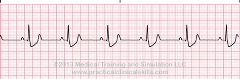 Image result for ECG Reading Practice