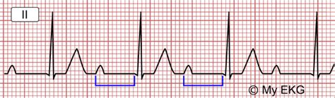 Image result for PR Interval Abnormalities