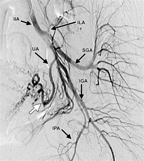 Image result for Angiogram with Embolization