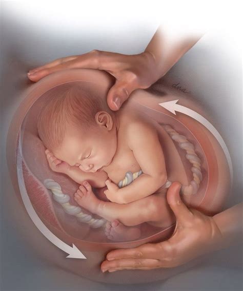 Image result for External Cephalic Version Step by Step