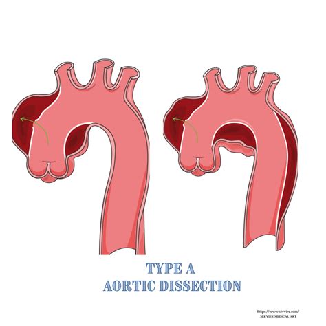 Image result for Type 2 Aortic Dissection