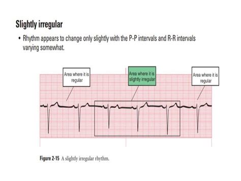 Image result for ECG Step by Step