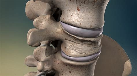 Image result for Surgery for Compression Fracture