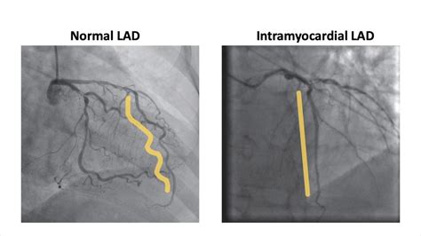Image result for Heart Block Angiogram