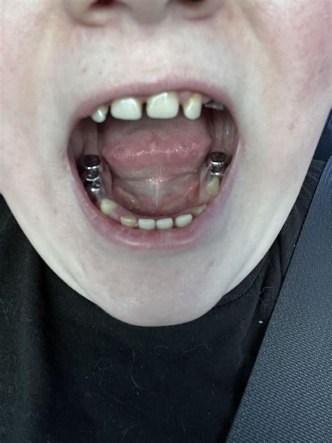 Image result for How to Process a Denture