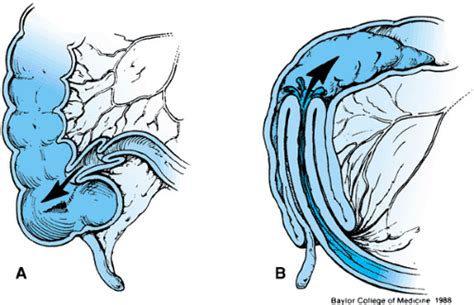 Intussusception | Musculoskeletal Key