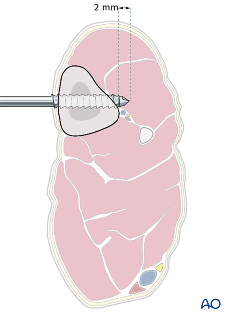 Image result for External Fixator Surgery