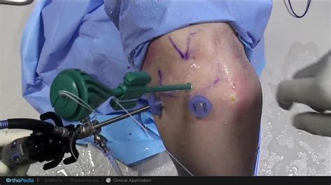 Image result for SpeedBridge Rotator Cuff