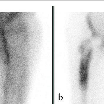 Image result for Triple Phase Bone Scan