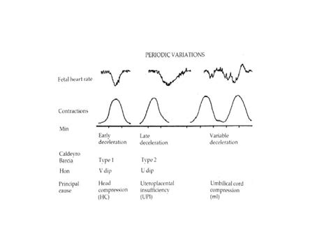 Image result for CTG and Partogram