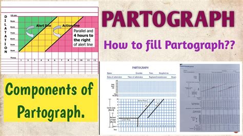 Image result for Normal Partograph