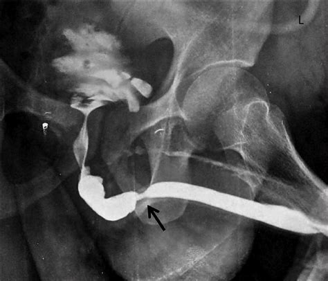 Image result for Rgu Retrograde Urethrogram