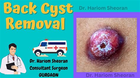 Image result for Upper-Back Cyst Surgery