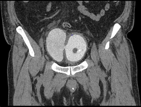 Image result for Delayed Phase CT Urogram