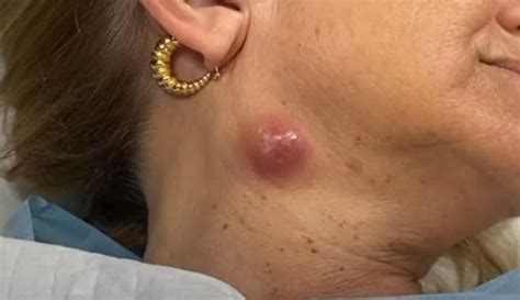 Image result for Big Exploding Cyst Neck
