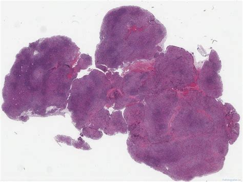 Image result for Diffuse Large Cell Lymphoma