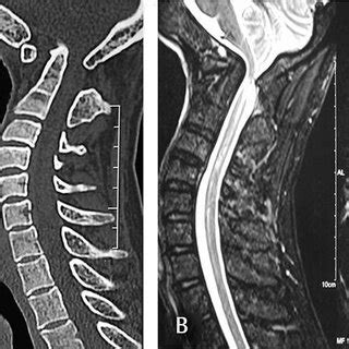 Image result for Basilary Invagination