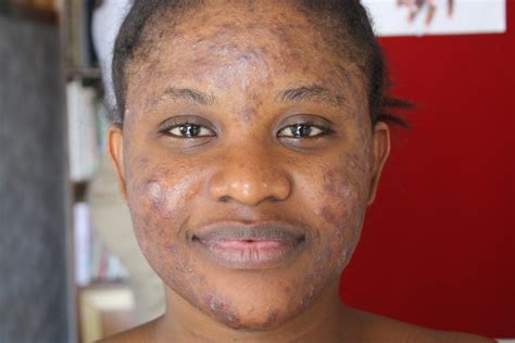 Image result for Exploding Bloody Pimples