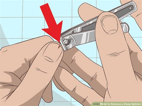Image result for Deep Splinter Removal
