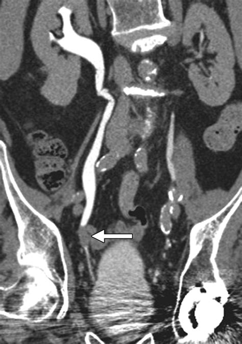 Image result for Volume-Rendered CT Urogram