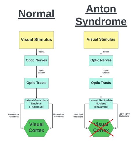 Image result for Visual Cortex Dysfunction