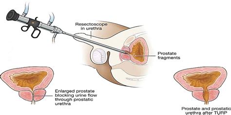 Image result for Transurethral Resection Procedure