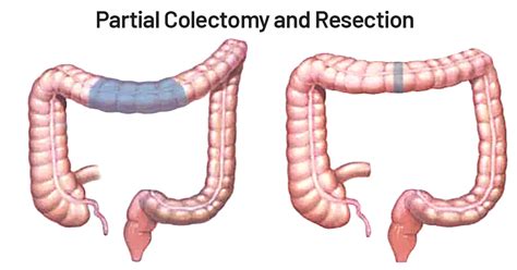 Image result for Colon Open Cancer Removal